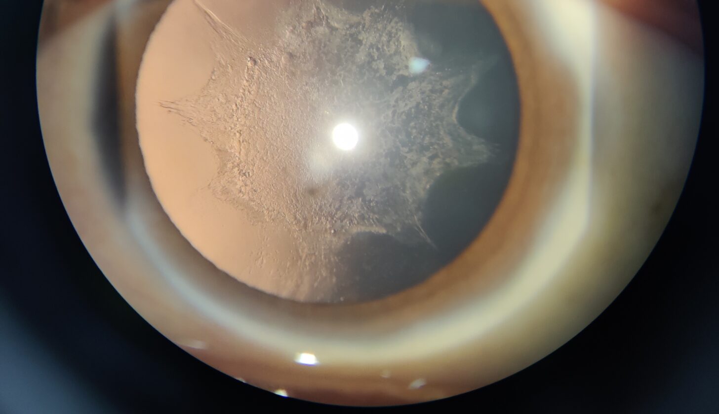 Complicated Cataract - MD Searchlight