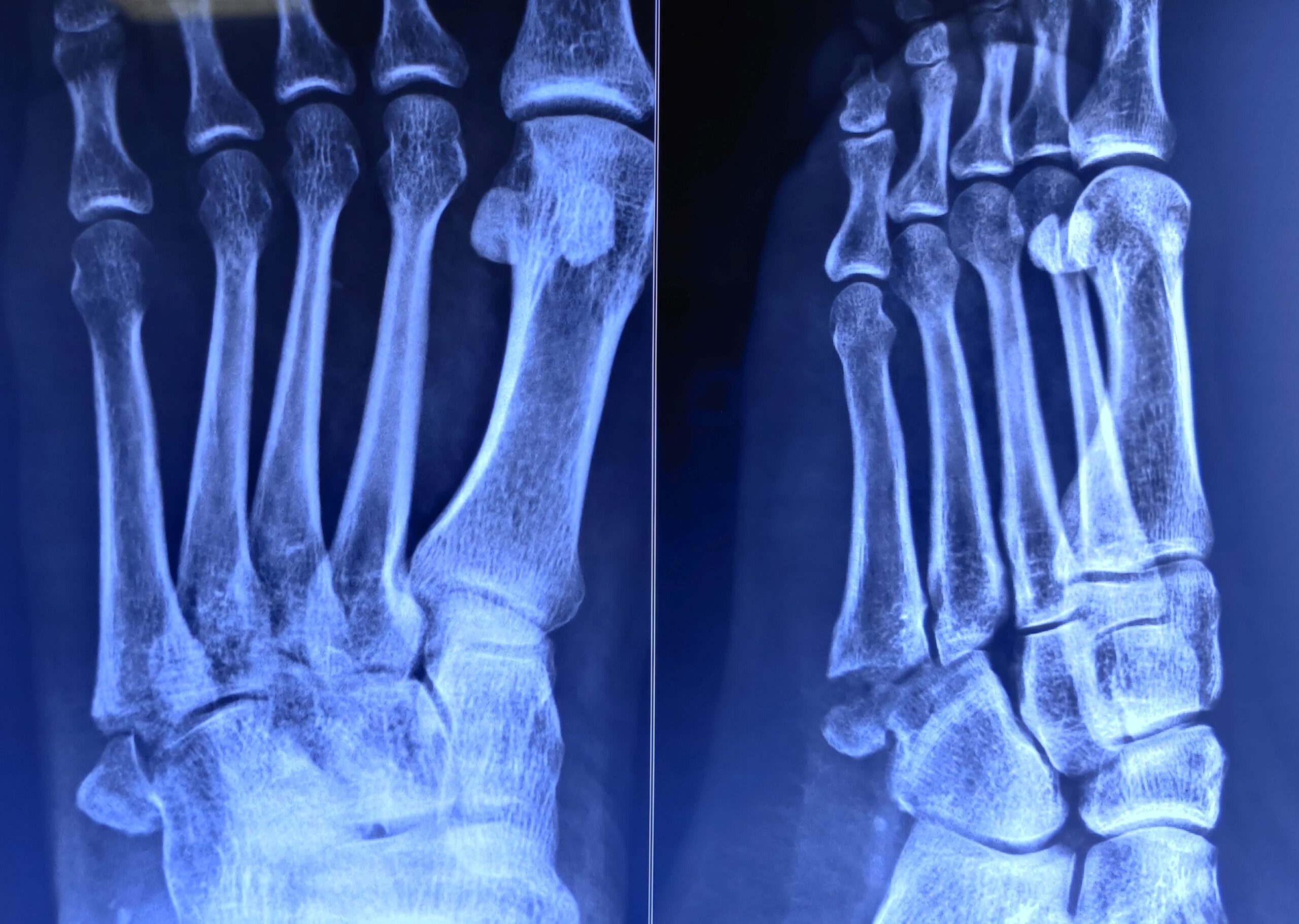 Metatarsal Fractures - MD Searchlight
