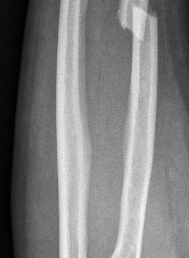 Forearm Fractures - MD Searchlight