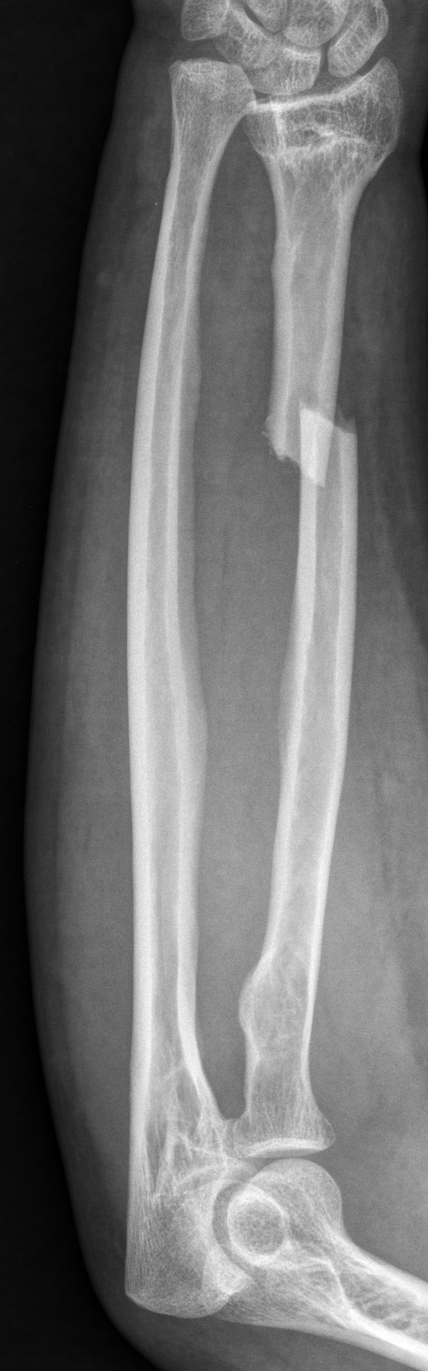 Forearm Fractures - MD Searchlight