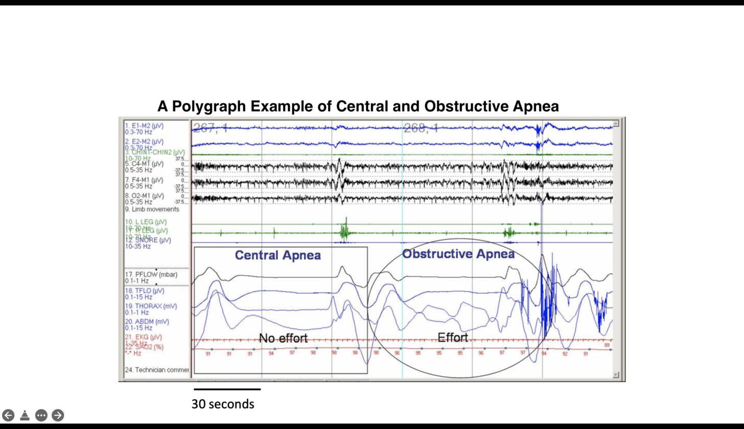 Central Sleep Apnea Md Searchlight