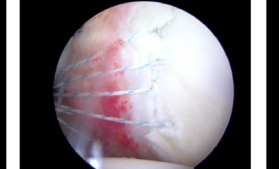 Anteroinferior Glenoid Labrum Lesion (Bankart Lesion) (Shoulder Joint ...