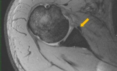 Anteroinferior Glenoid Labrum Lesion (Bankart Lesion) (Shoulder Joint ...
