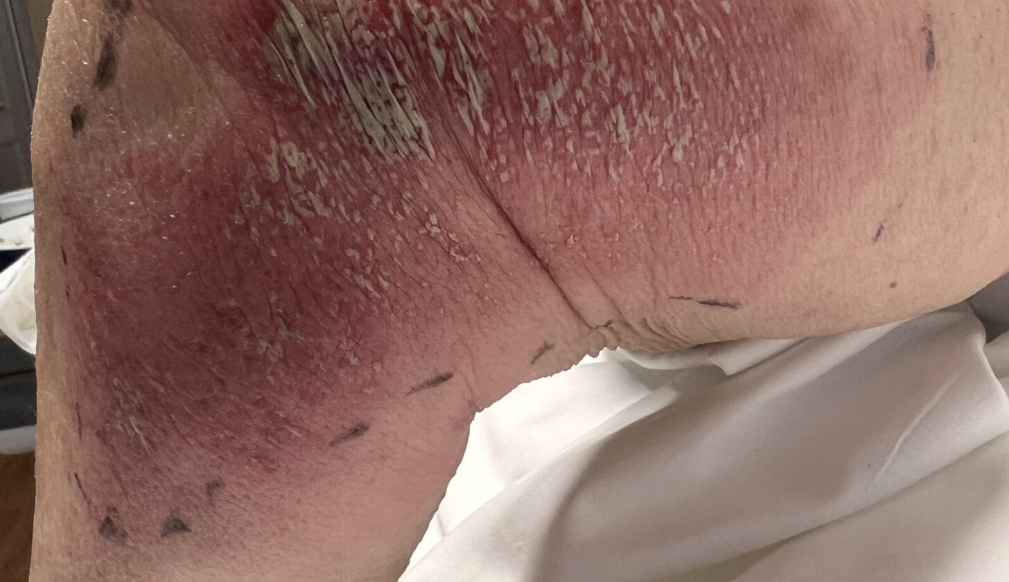 Acute Generalized Exanthematous Pustulosis - MD Searchlight