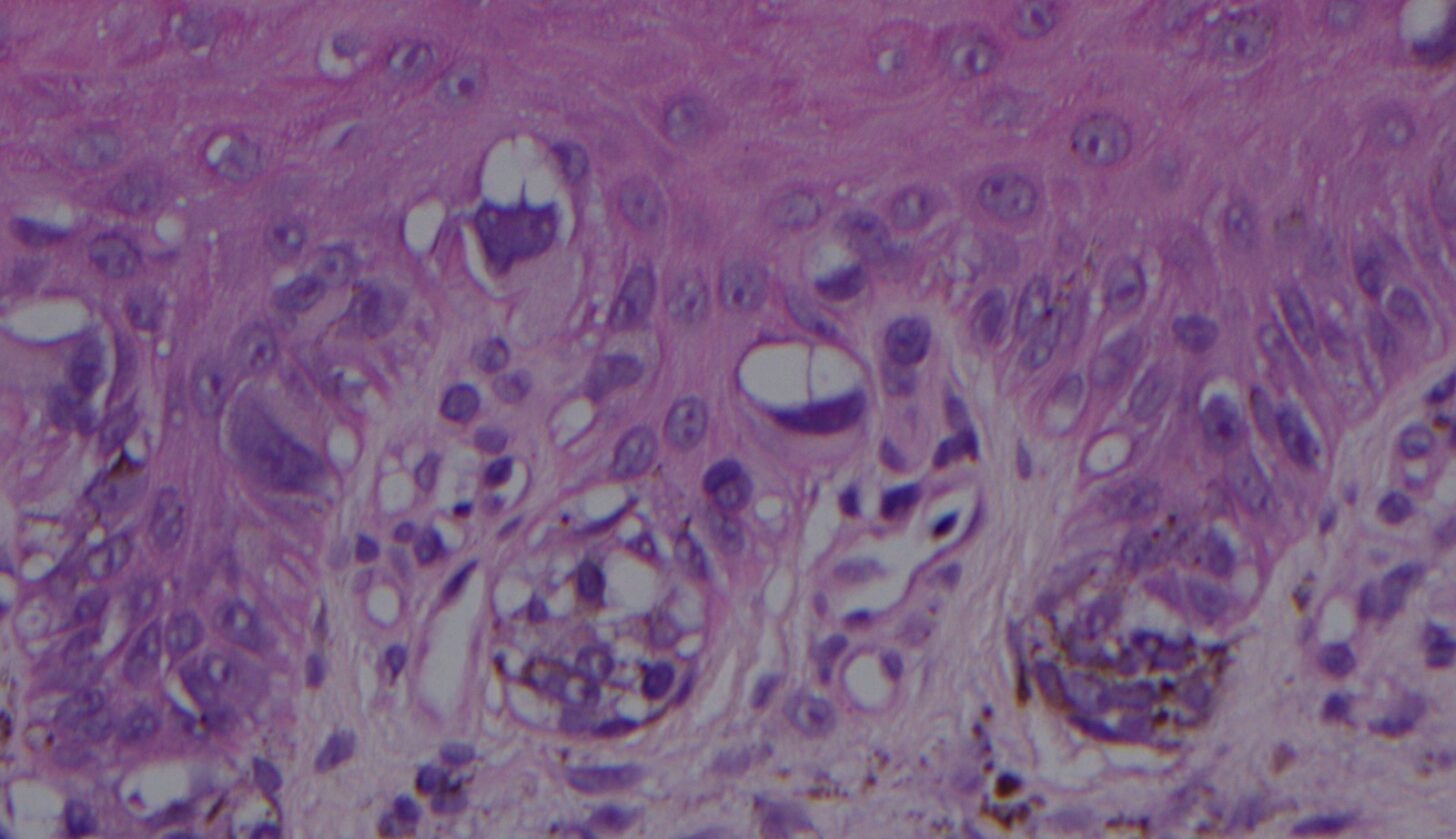 Acral Lentiginous Melanoma - MD Searchlight