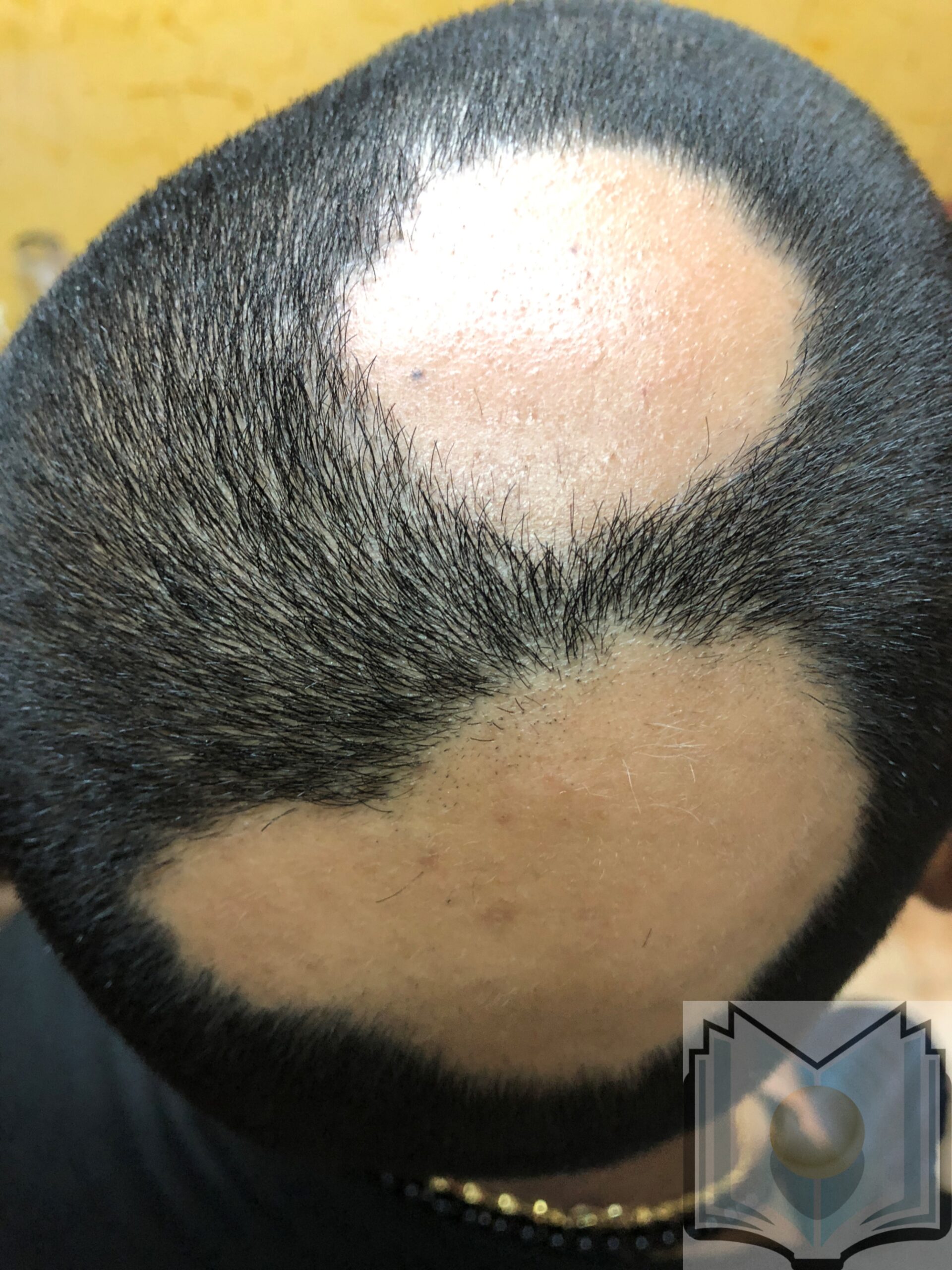 Alopecia Areata - MD Searchlight