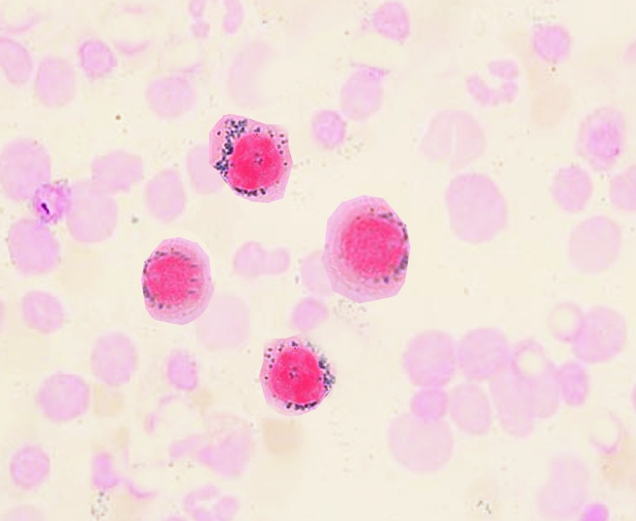 Refractory Anemia With Ring Sideroblasts - MD Searchlight
