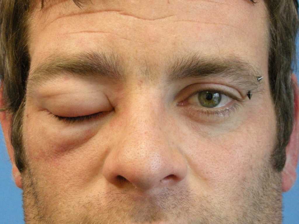 Acquired Angioedema - MD Searchlight