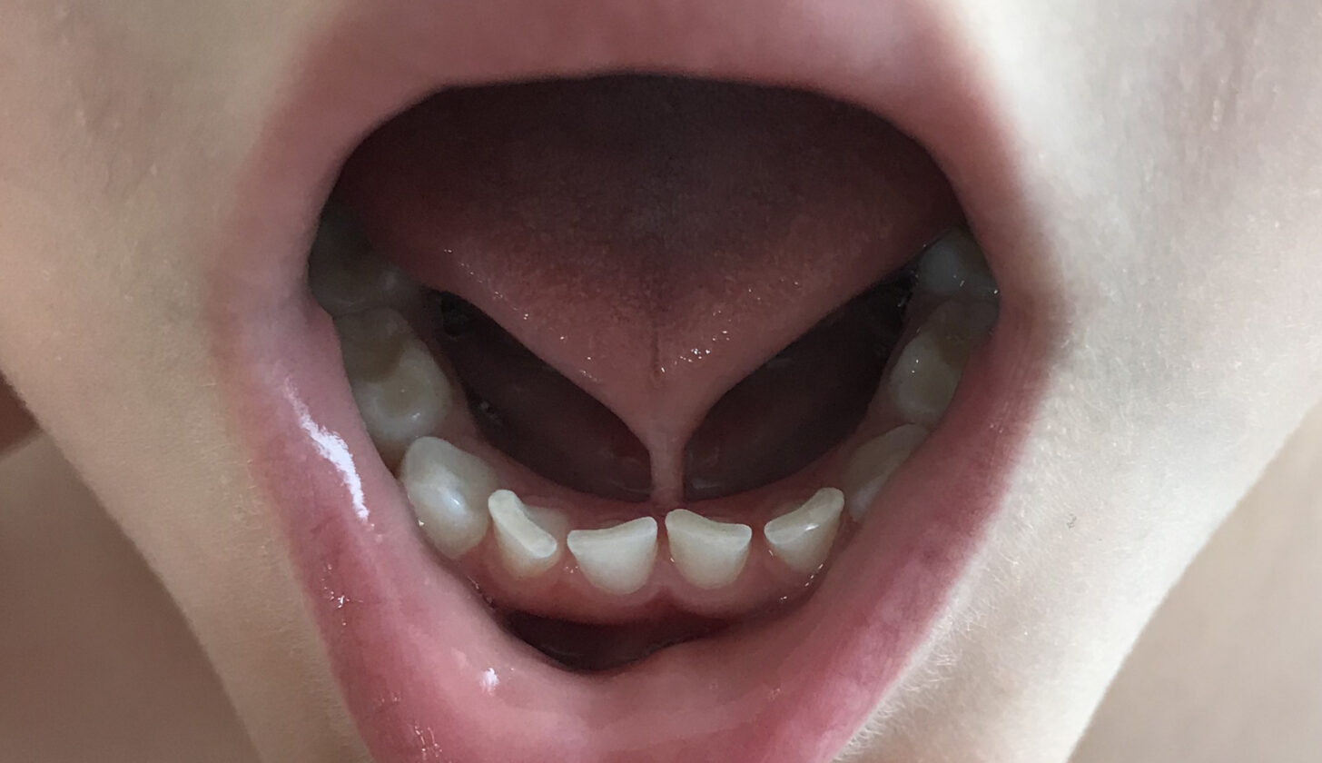 Ankyloglossia (Tongue-Tie) (Tongue-Tie) - MD Searchlight