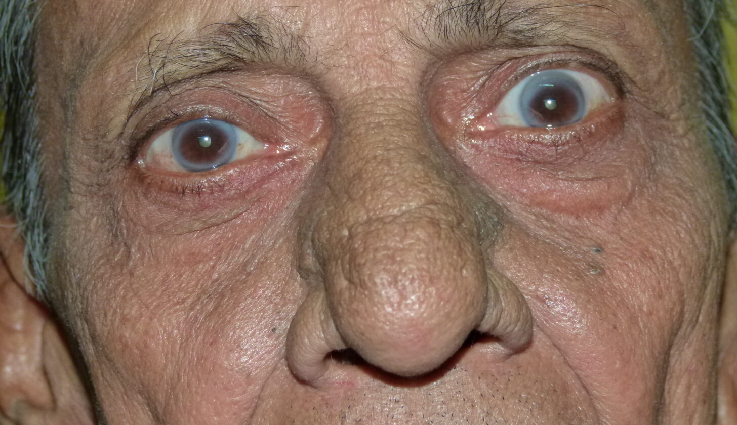 Arcus Senilis - MD Searchlight