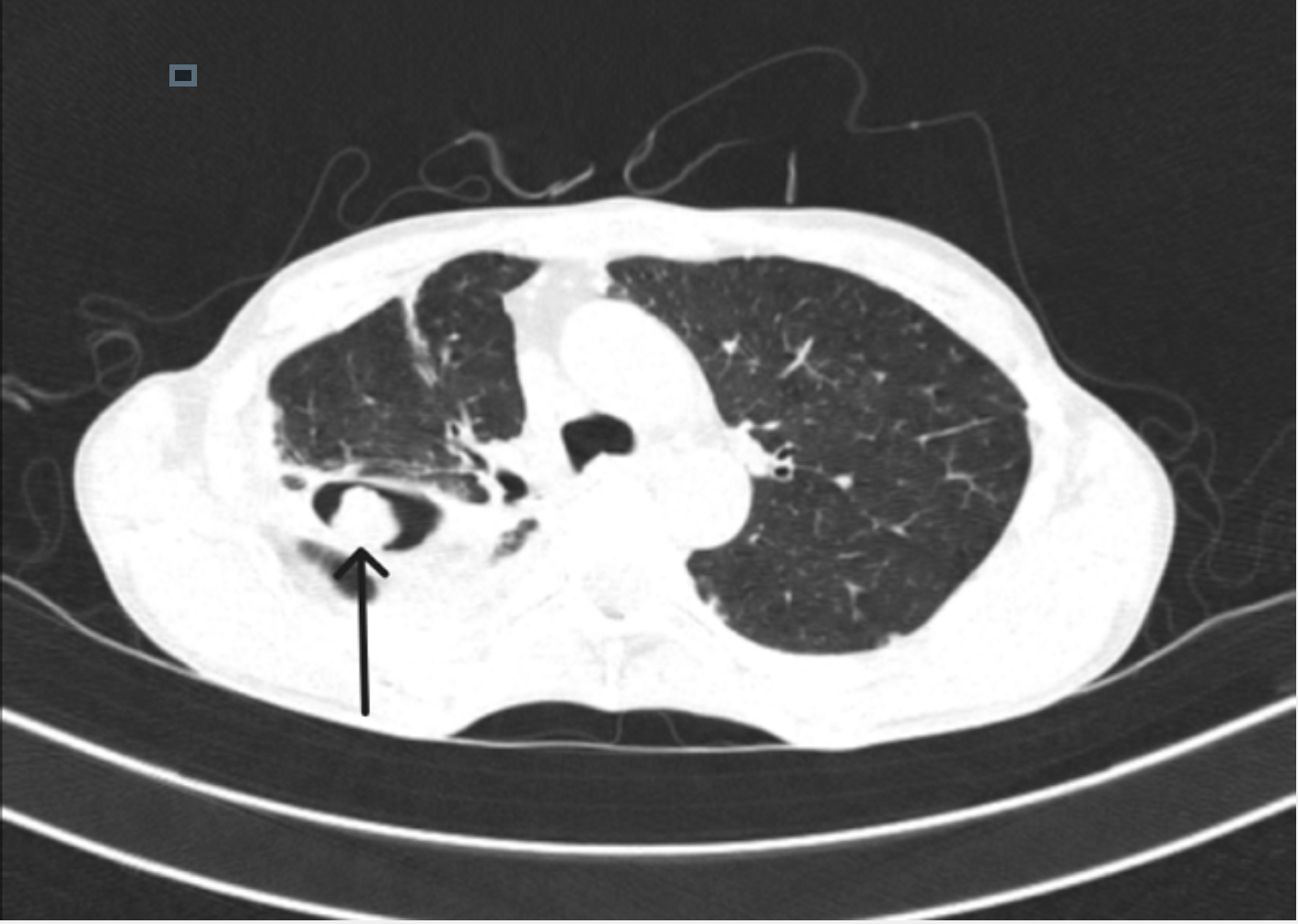 Aspergilloma - MD Searchlight