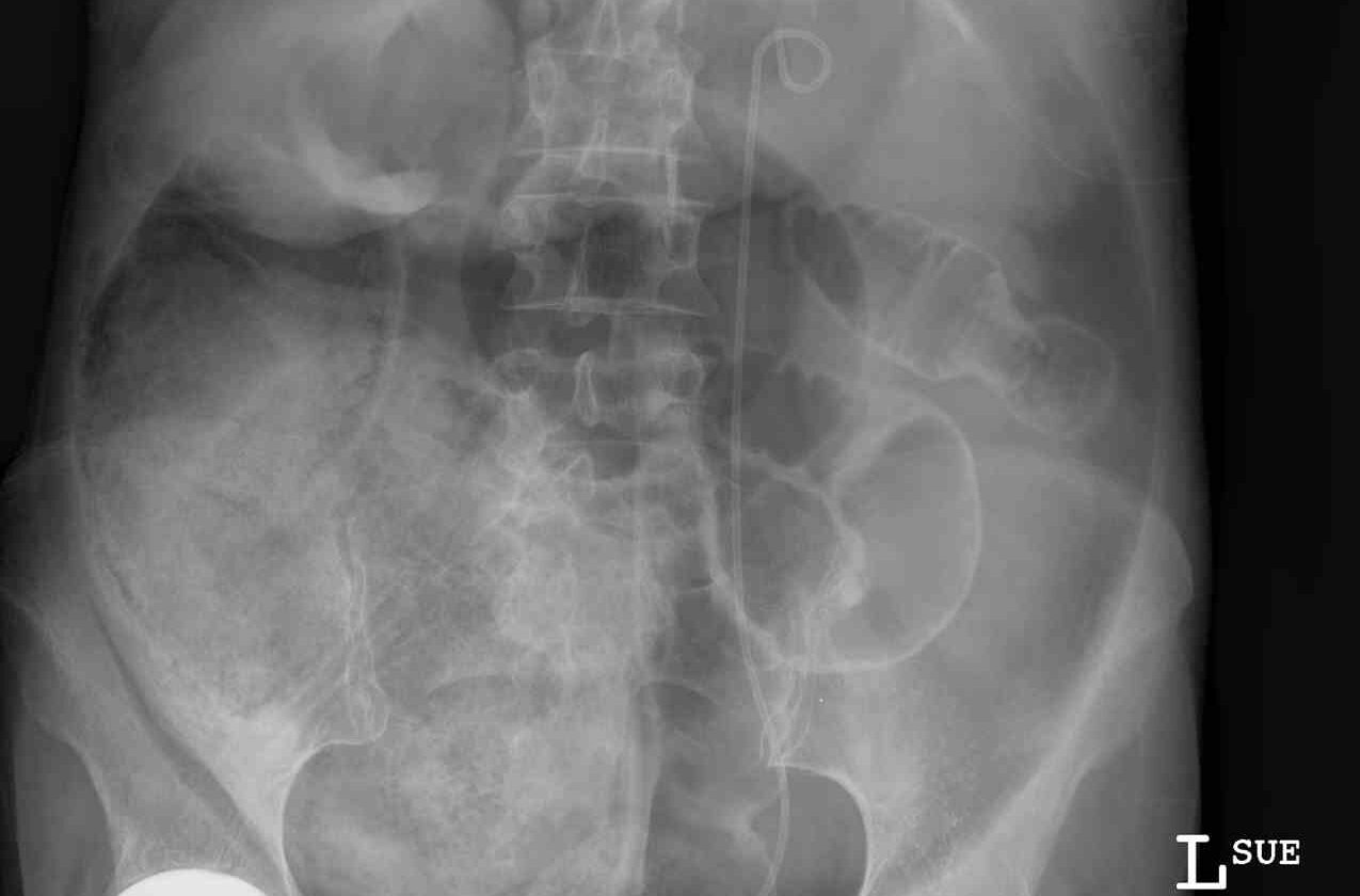 Bowel Perforation - MD Searchlight