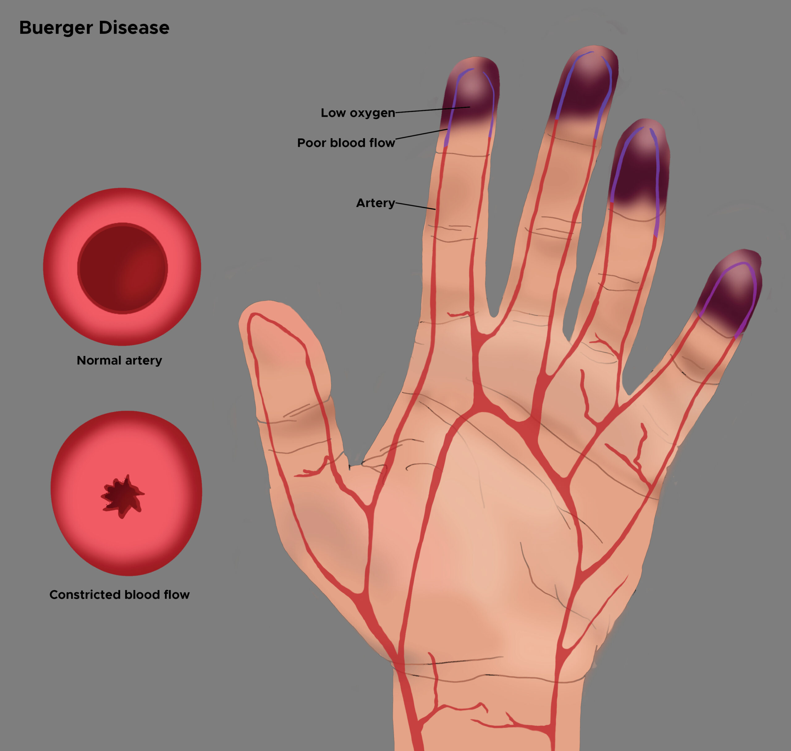Buerger Disease - MD Searchlight