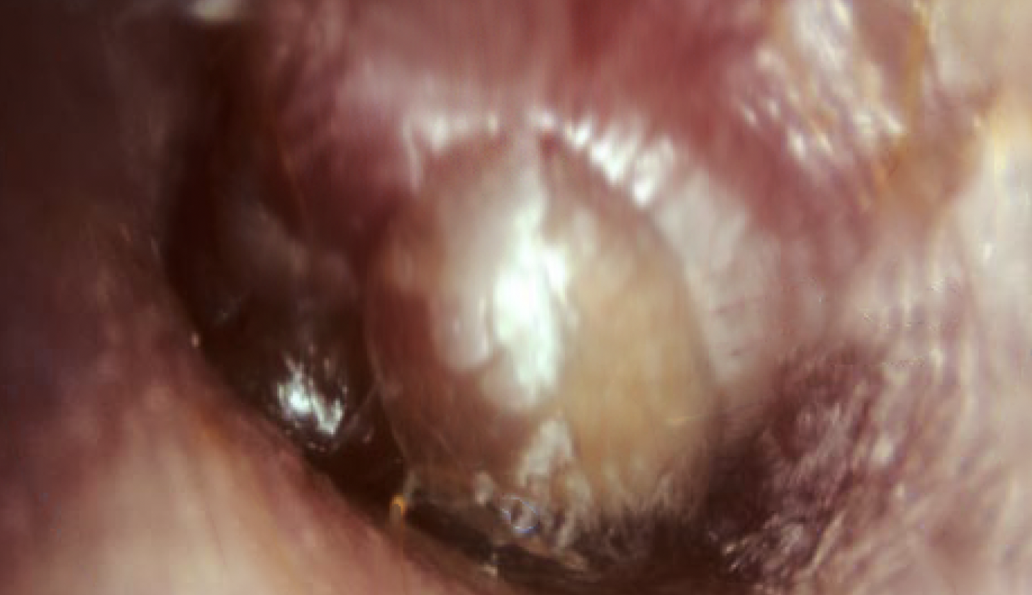 Bullous Myringitis - MD Searchlight