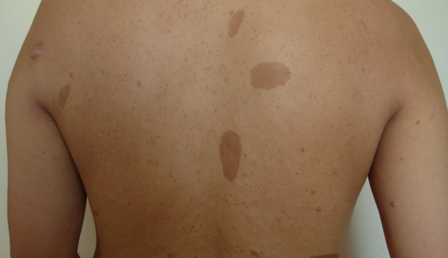 Cafe Au Lait Macules - MD Searchlight