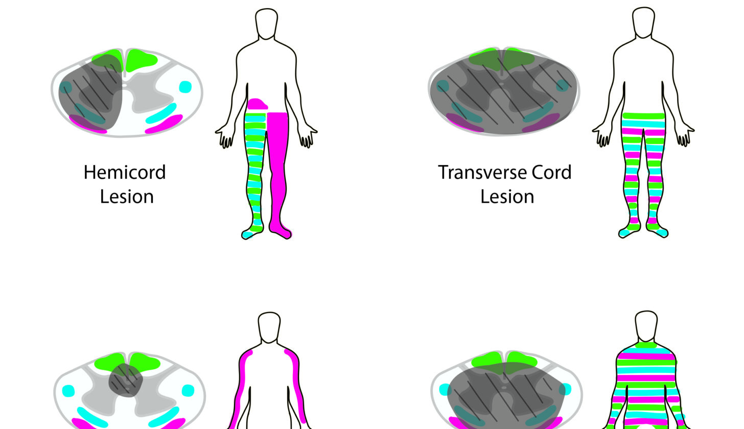 Central Cord Syndrome - MD Searchlight