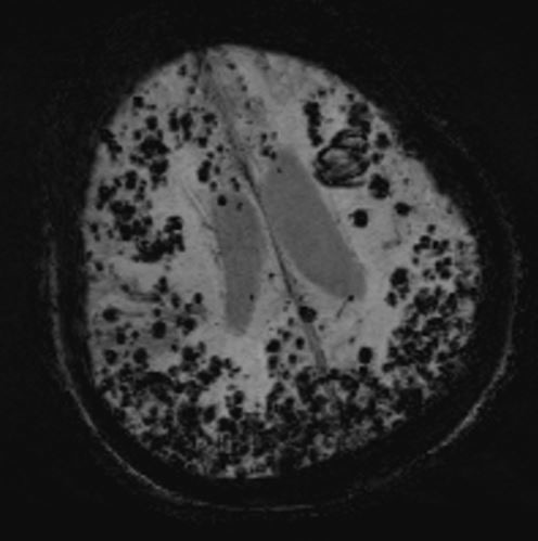 Cerebral Amyloid Angiopathy - MD Searchlight