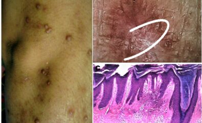 Confluent and Reticulated Papillomatosis - MD Searchlight