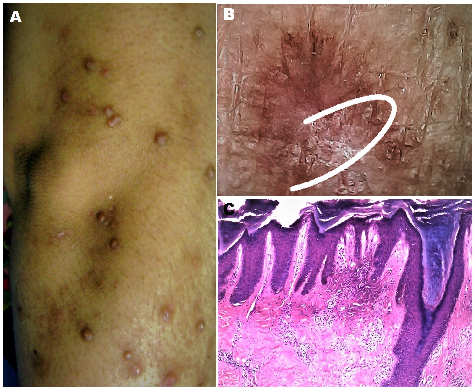 Confluent and Reticulated Papillomatosis - MD Searchlight