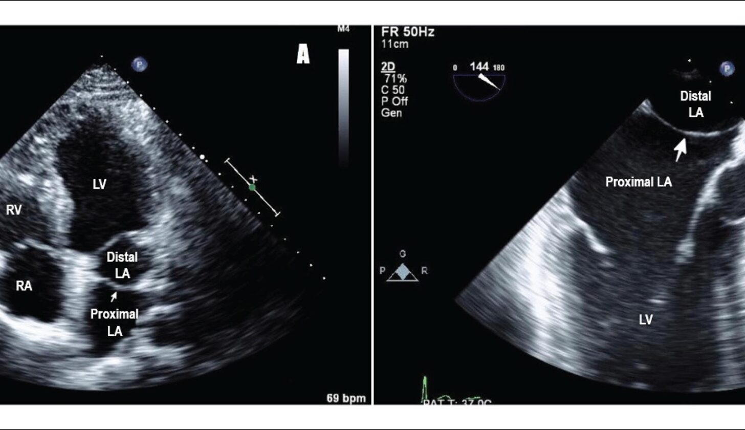 Cor Triatriatum - MD Searchlight