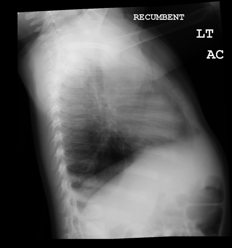 Congenital Pulmonary Airway Malformation - MD Searchlight