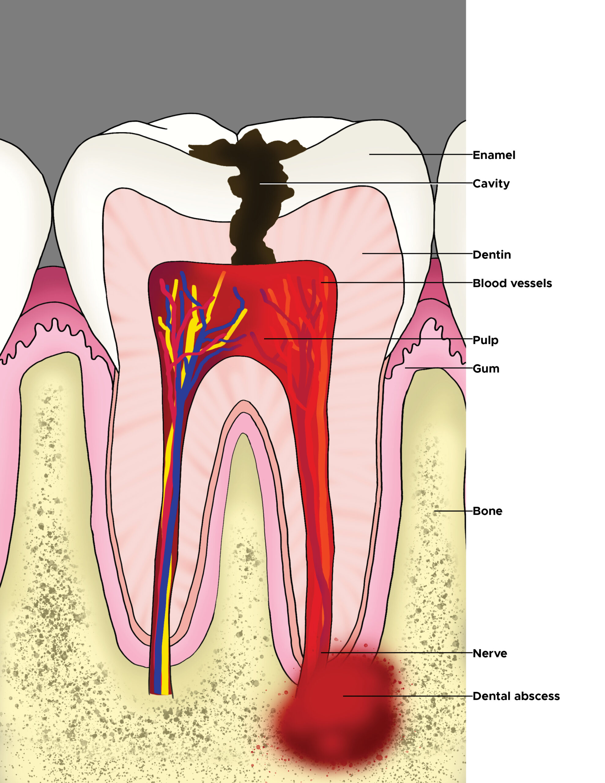 Dental Abscess (Cavities) - MD Searchlight