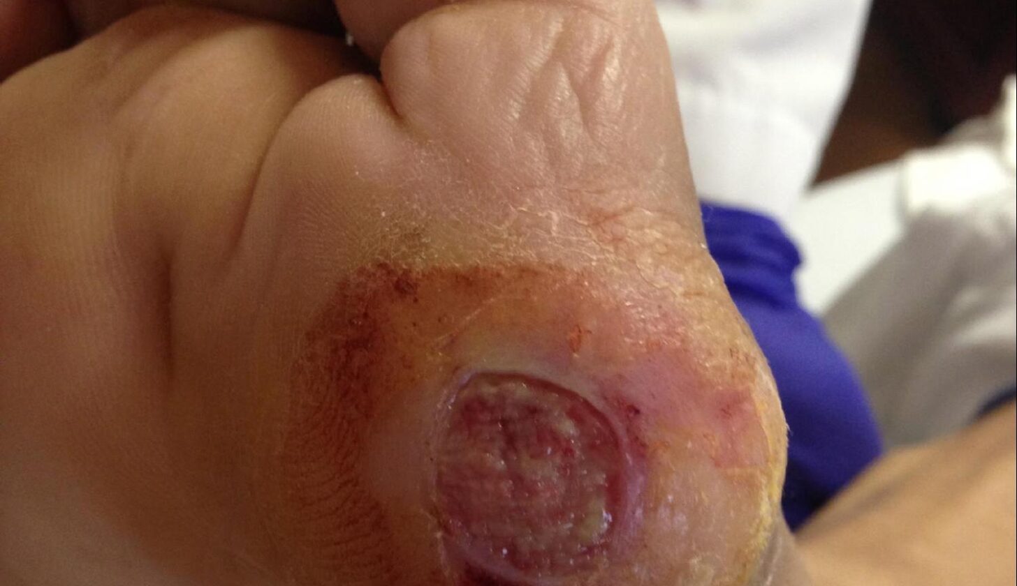 Diabetic Ulcer - MD Searchlight