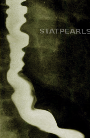 Diffuse Esophageal Spasm - MD Searchlight