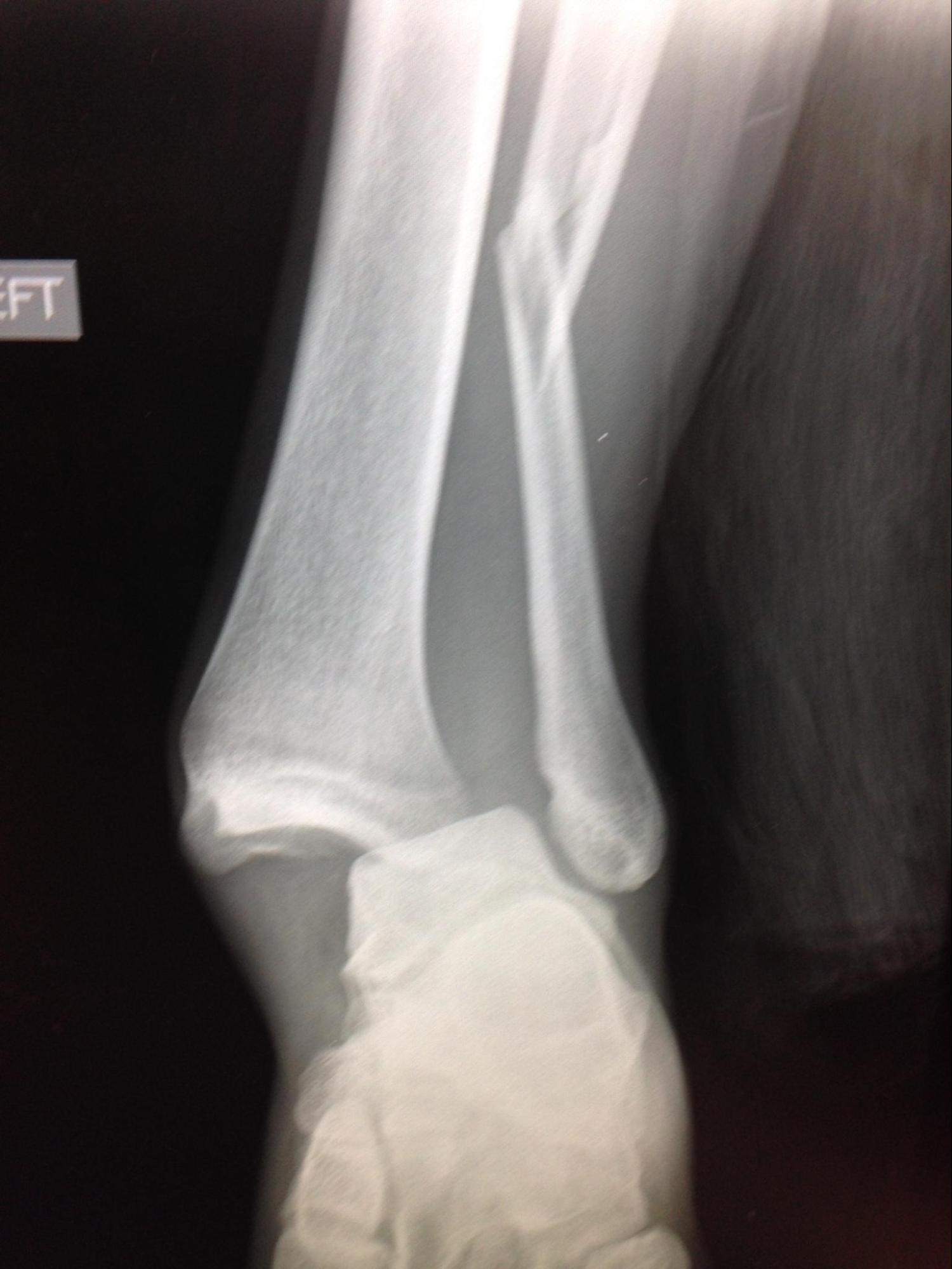 Foot Dislocation (Foot Bones Popped Out) - MD Searchlight