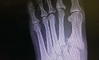Foot Dislocation (Foot Bones Popped Out) - MD Searchlight