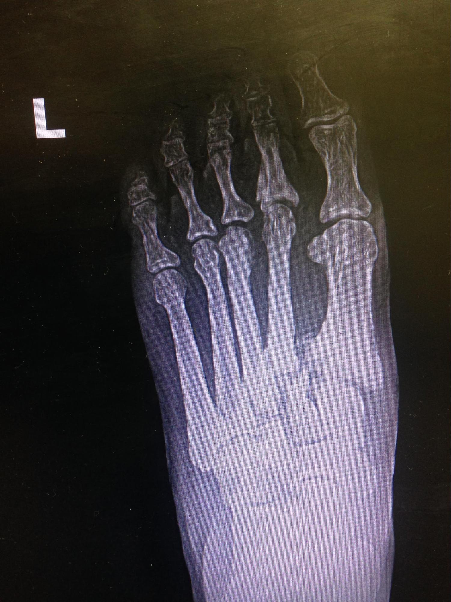 Foot Dislocation (Foot Bones Popped Out) - MD Searchlight