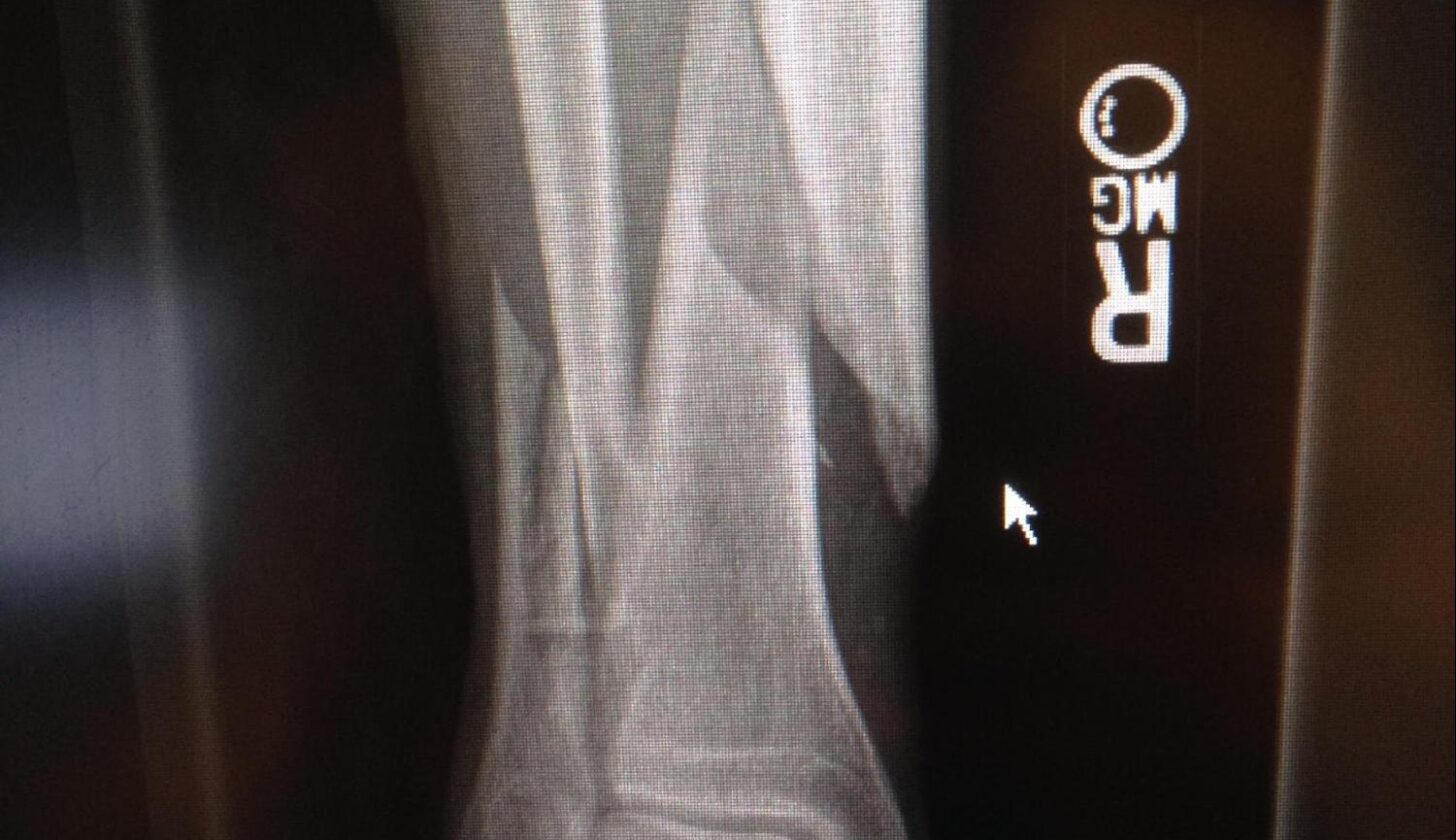 Fibula Fractures - MD Searchlight