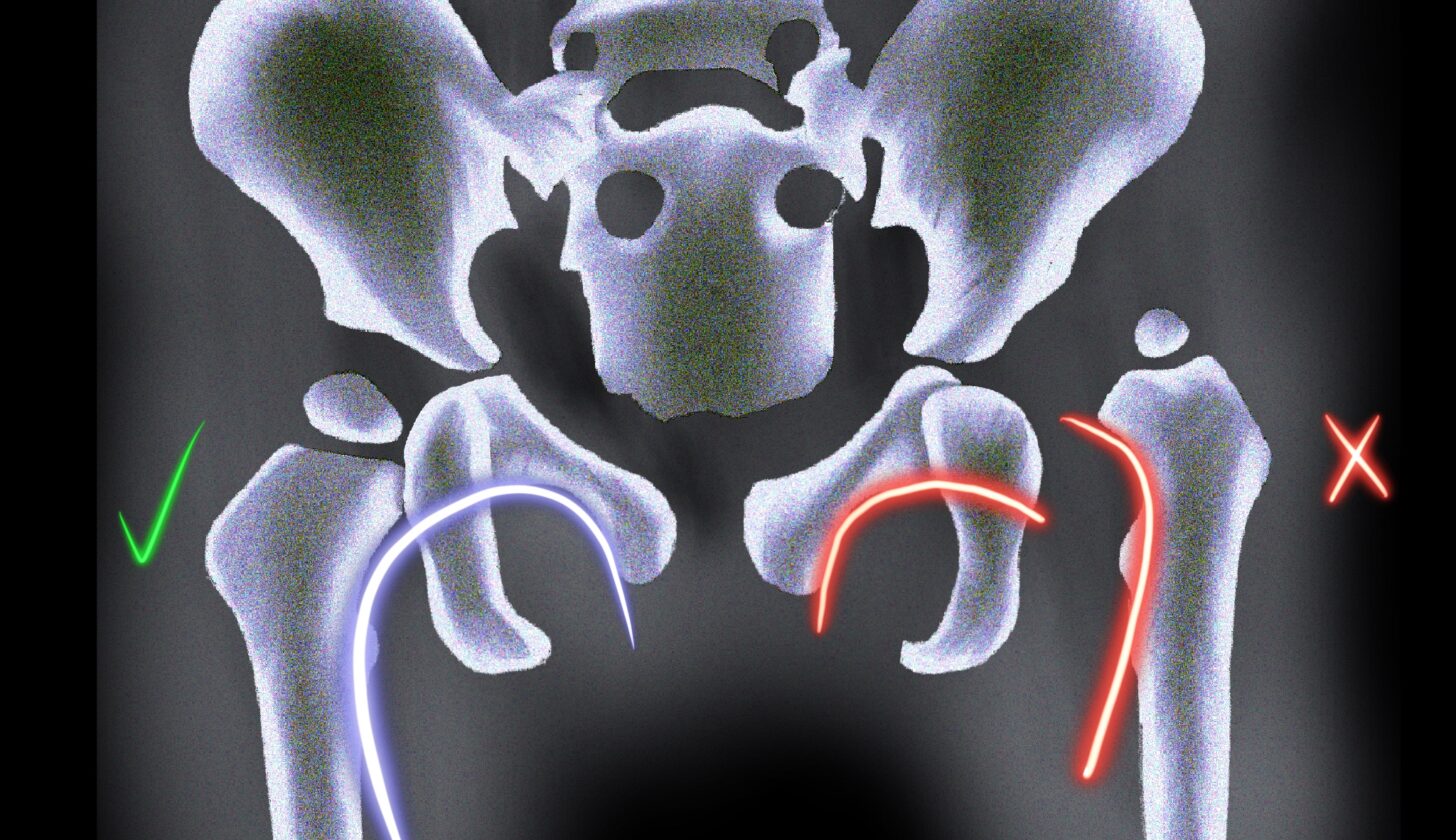 Developmental Dysplasia of the Hip - MD Searchlight