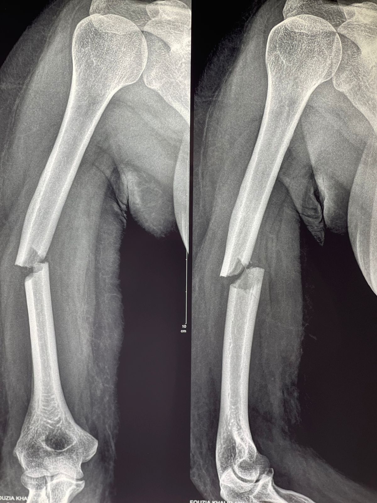 Humeral Shaft Fractures - MD Searchlight