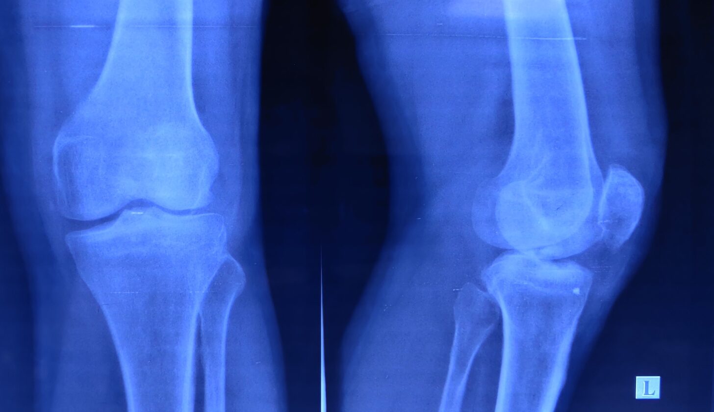 Tibial Eminence Fractures - MD Searchlight