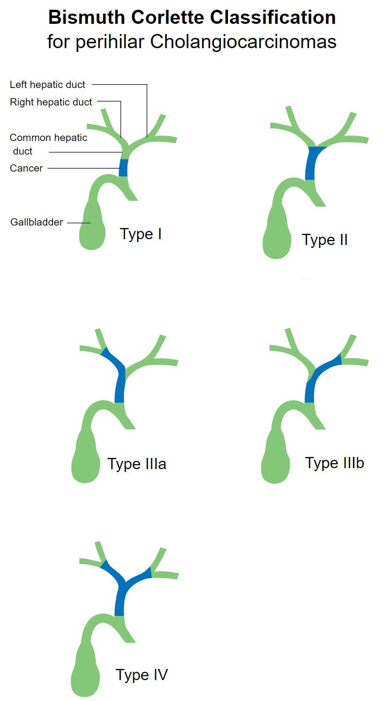 Cholangiocarcinoma (Bile Duct Cancer) - MD Searchlight