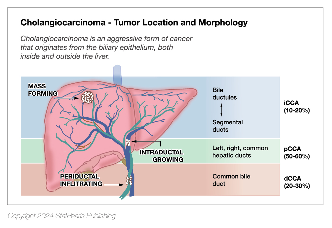 Cholangiocarcinoma (Bile Duct Cancer) - MD Searchlight