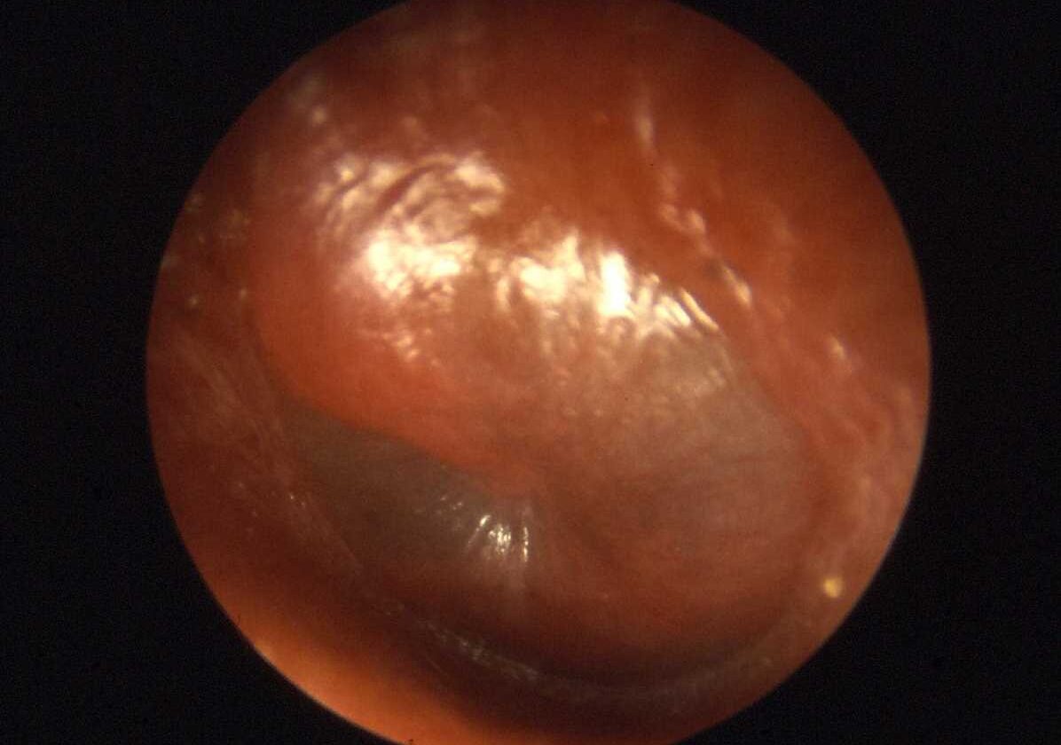 Otitis Media With Effusion - MD Searchlight