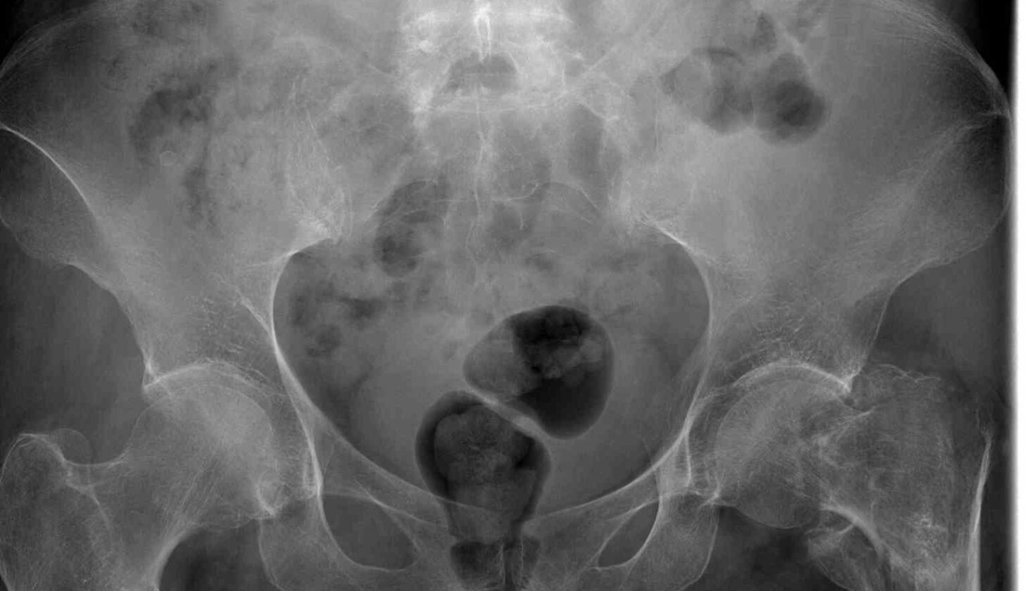 Pelvic Trauma (Hip and Lower Abdomen Injury) - MD Searchlight