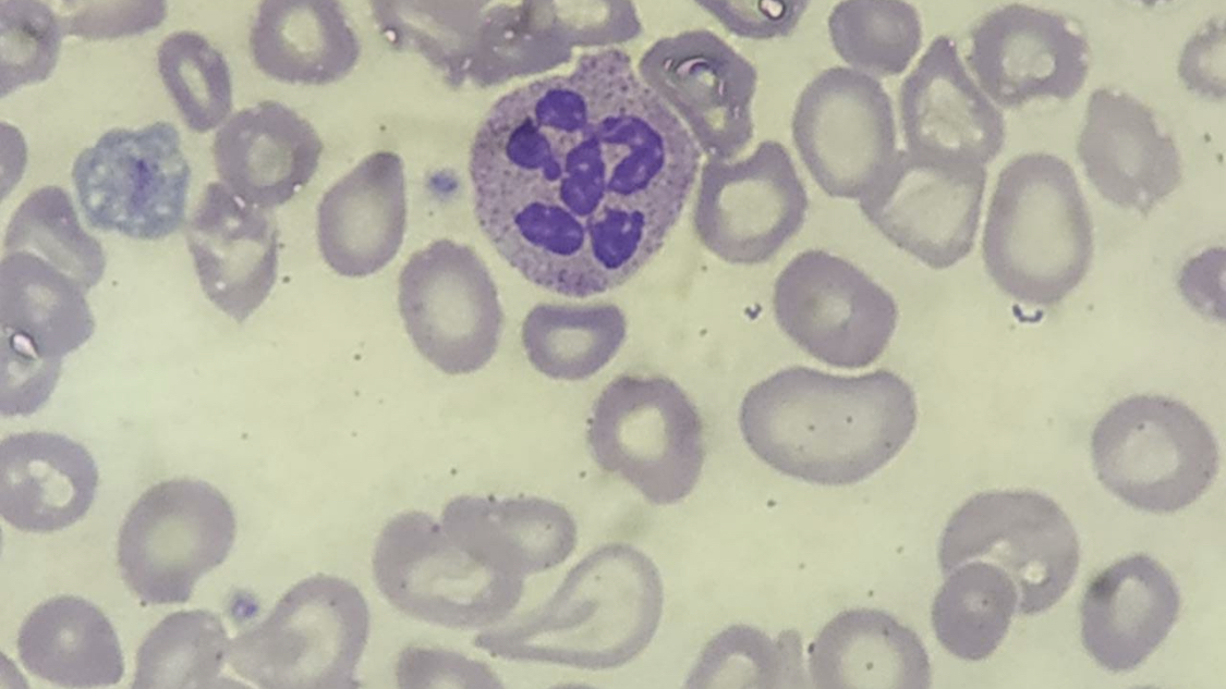 Pernicious Anemia - MD Searchlight