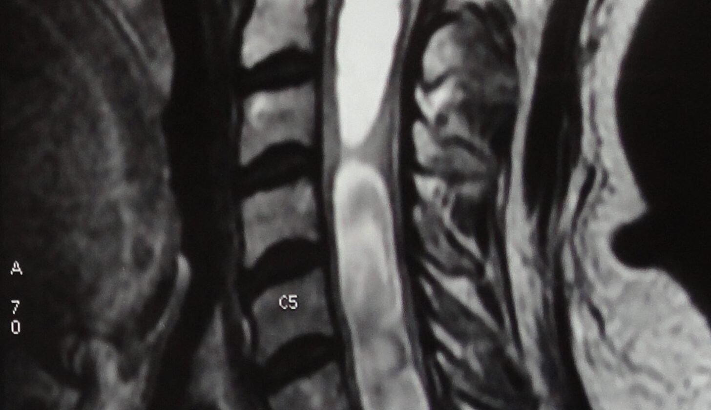 Posttraumatic Syringomyelia (Spine Swelling after Injury) - MD Searchlight
