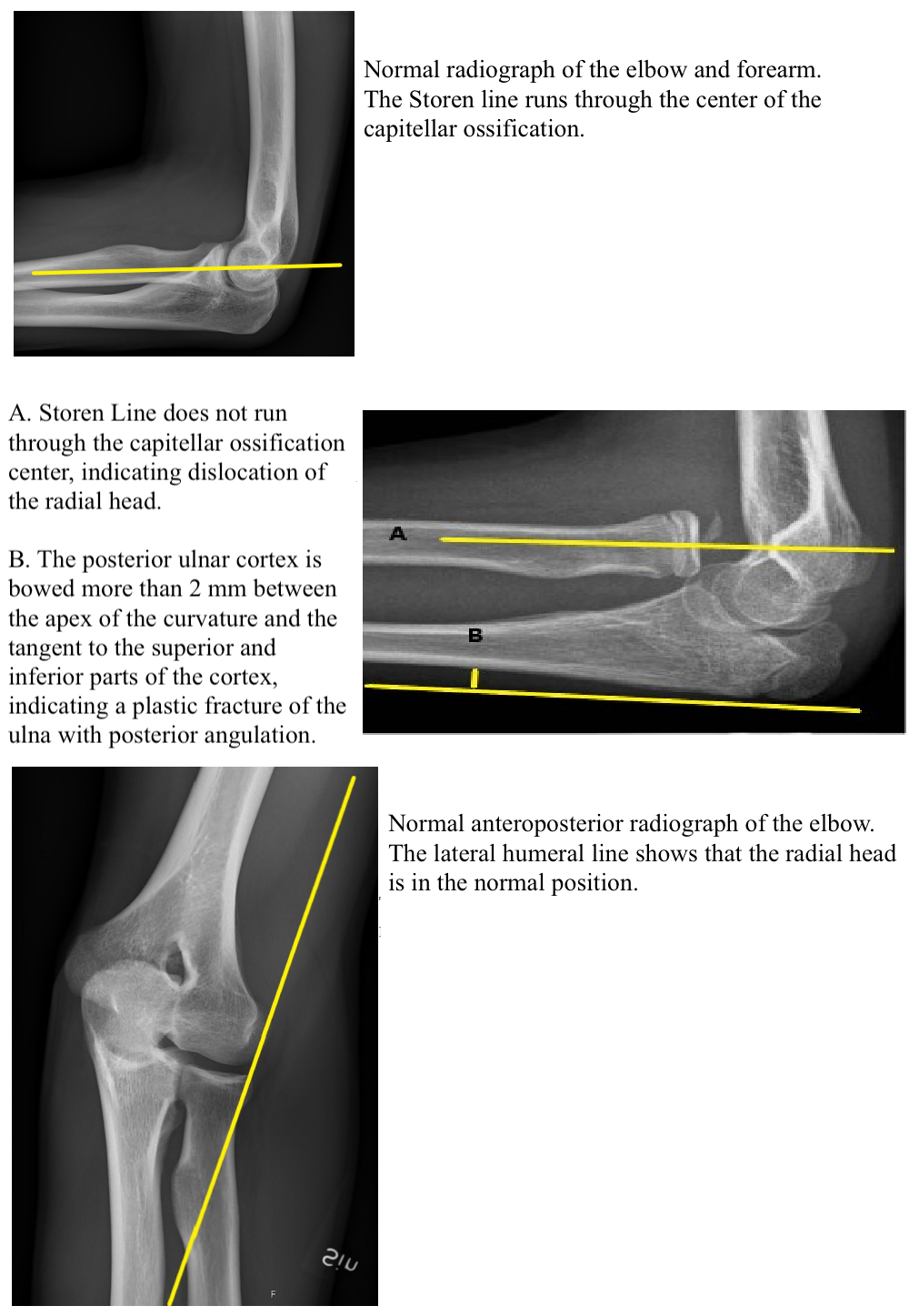 Radial Head Dislocation - MD Searchlight