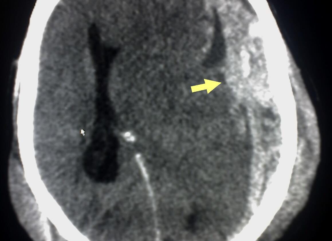 Pediatric Abusive Head Trauma (Head Injury in Abused Children) - MD ...