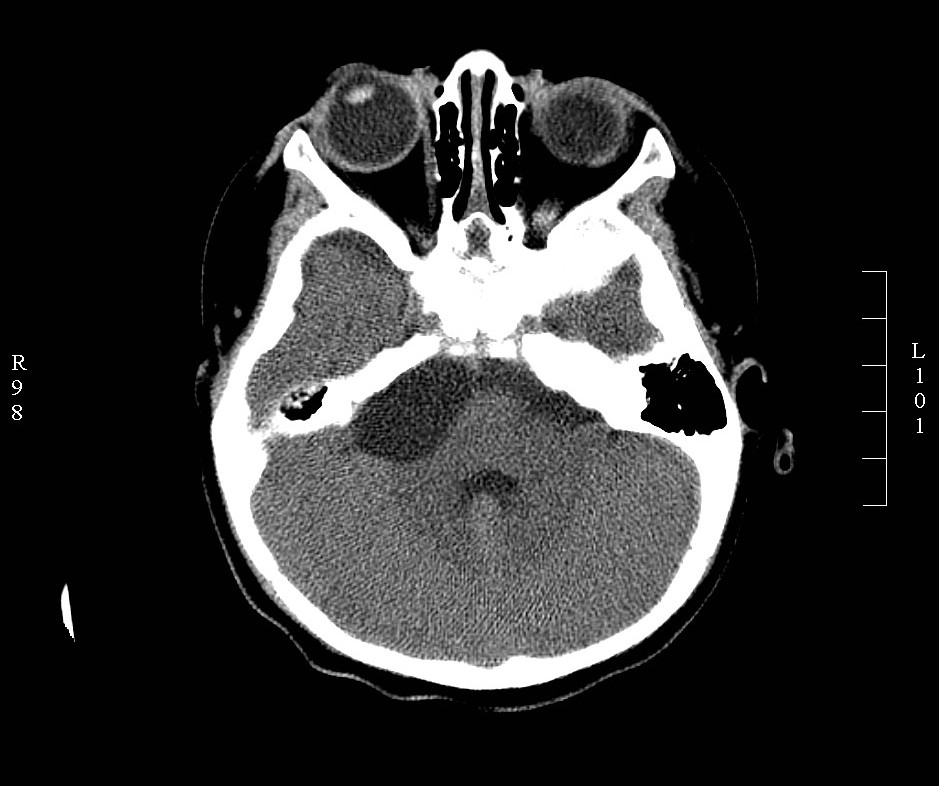 Cerebellopontine Angle Cancer - MD Searchlight