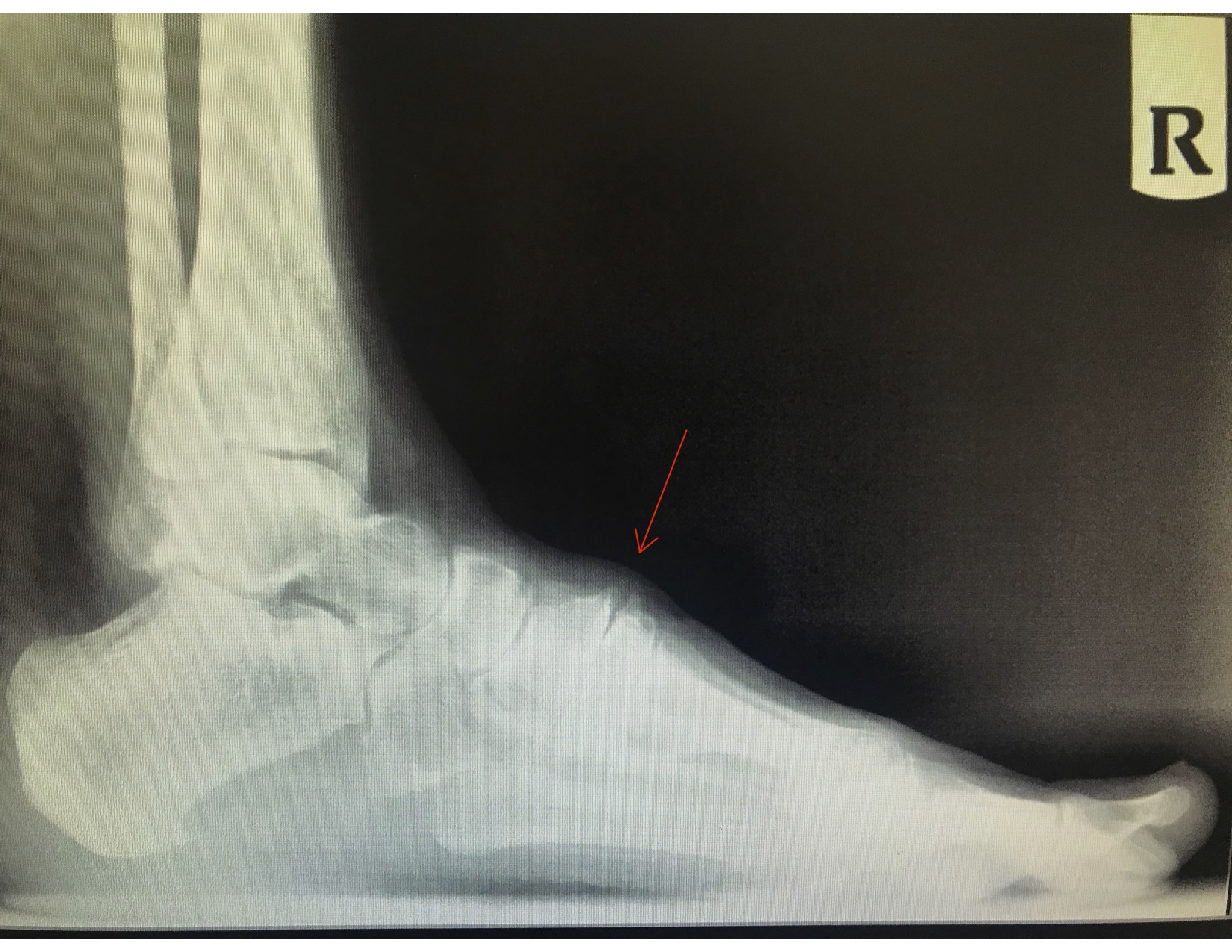 Peroneal Nerve Entrapment Test
