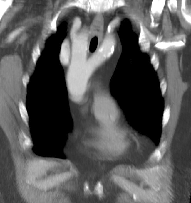 Double Aortic Arch - MD Searchlight