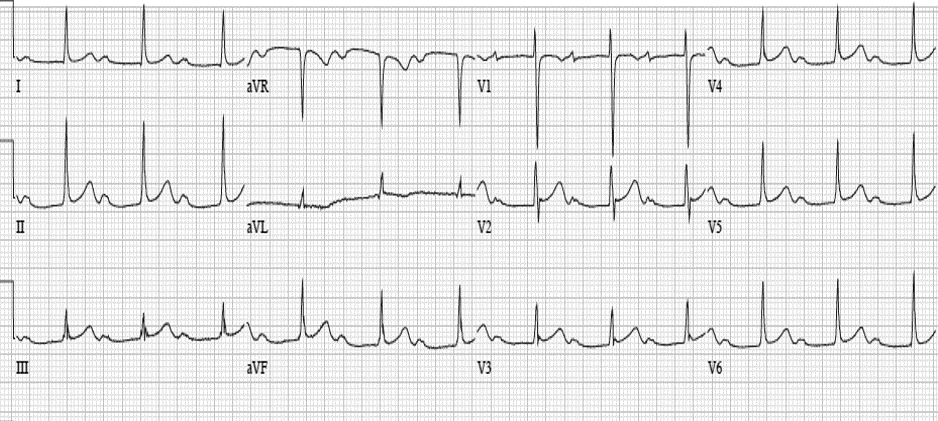 Atrioventricular Block - MD Searchlight