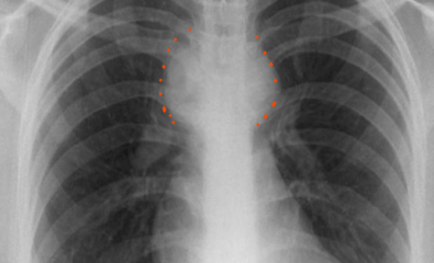 Adenopathy - MD Searchlight