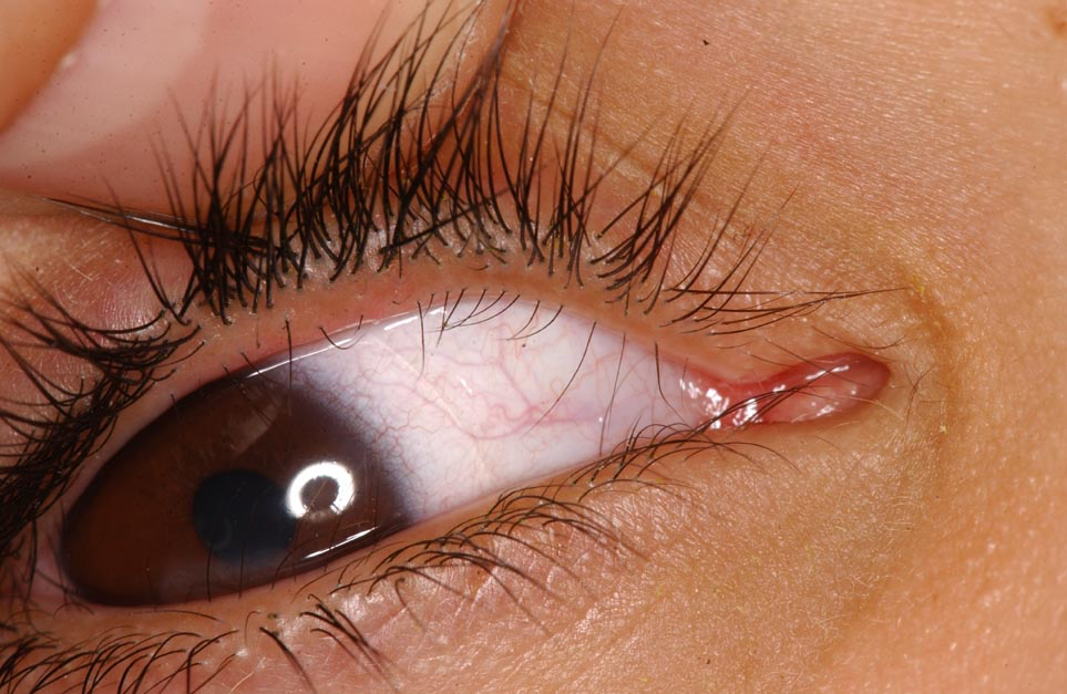 Diseases of the Eyelashes - MD Searchlight
