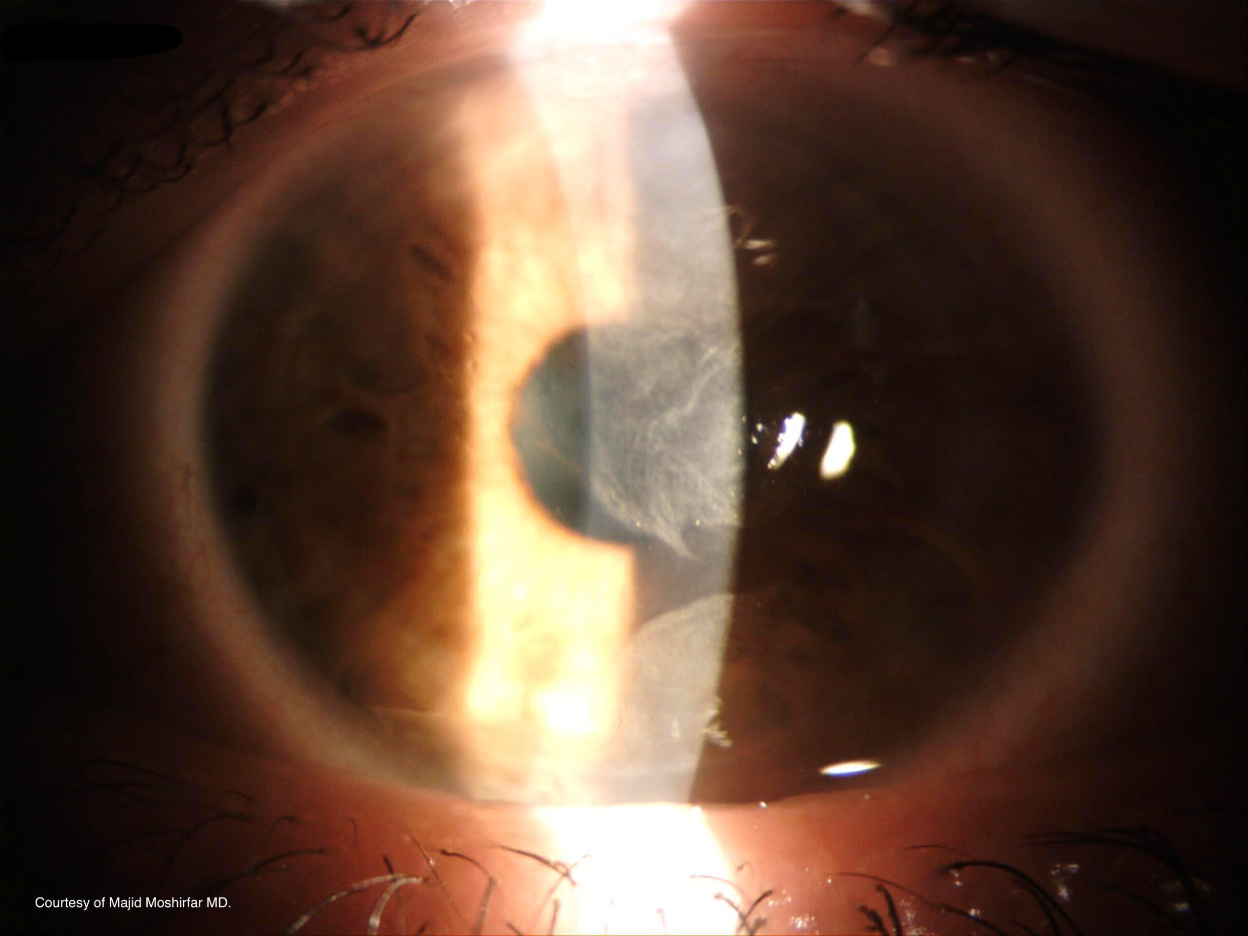 Advancing Wavelike Epitheliopathy - MD Searchlight